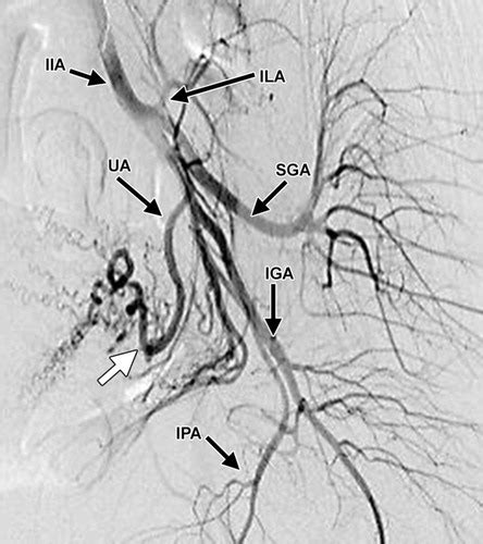Uterine Artery Embolization For Postpartum Hemorrhage