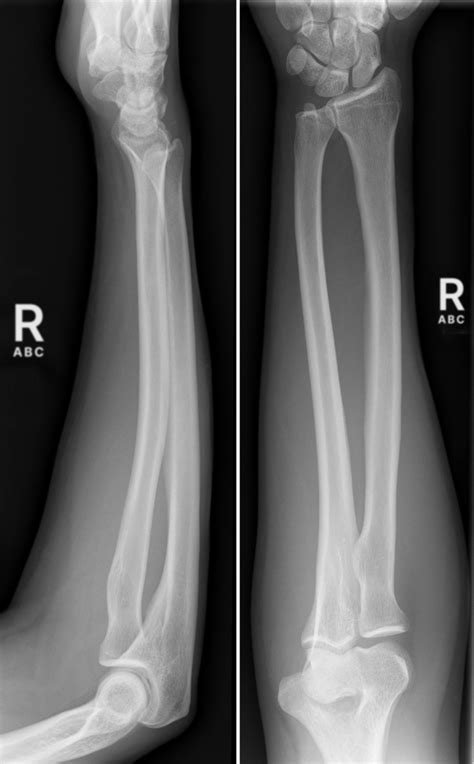 Forearm ~ Anteroposterior Ap And Lateral Diagram Quizlet