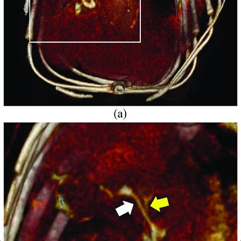 A Three Dimensional Volume Rendered Ct Images From Ct Cholangiography