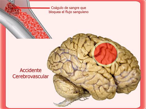 Ictus Rehabilitación Fisioterapia Neurológica