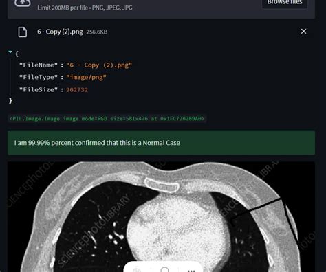 Github Vedantkadam Lung Cancer Cnn Lung Cancer Detection Using