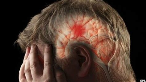 ¿cómo Identificar Los Síntomas De Un Derrame Cerebral Noticias Telemicro