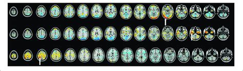 Seed Based Correlation Map Of A Single Patient With 3 Representative