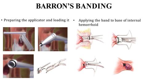 Hemorrhoidectomy Surgical Procedure Raf Pptx