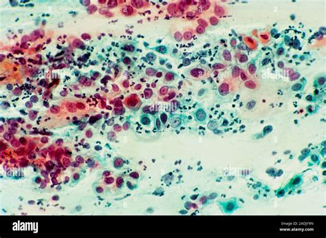 Severe Dysplasia Of Cervix Light Micrograph Of A Cervical Smear