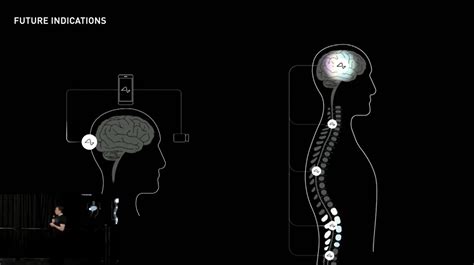 Elon Musk Cree Que En Seis Meses Su Empresa Neuralink Implantará El