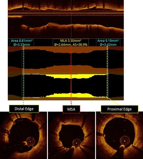Intravascular Oct In Pci American College Of Cardiology