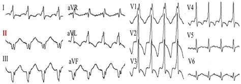 Algorithms To Identify Accessory Pathways Location On The 12 Lead
