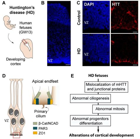 Abnormalities Of Human Cortical Development In Huntingtons Disease