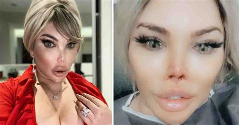 Ex Ken Humano Faz Nova Cirurgia No Nariz E No Queixo IstoÉ Independente
