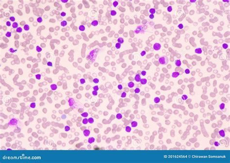 Célula Moderada Blástica De Los Glóbulos Blancos En La Mancha De Sangre