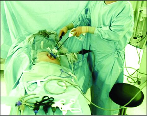 Solo Single Incision Laparoscopic Appendectomy Download Scientific