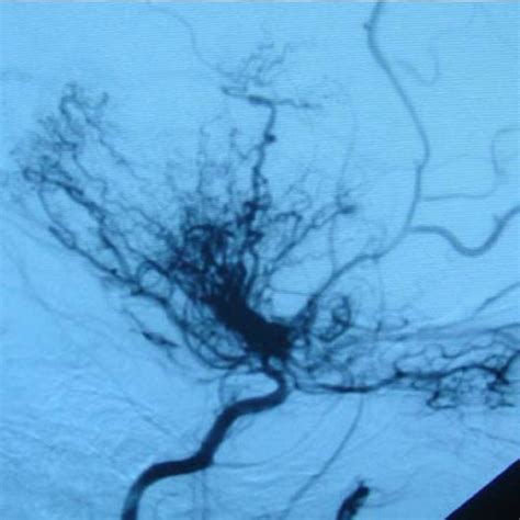 Cerebral Digital Subtraction Lica Angiogram Lateral View Shows