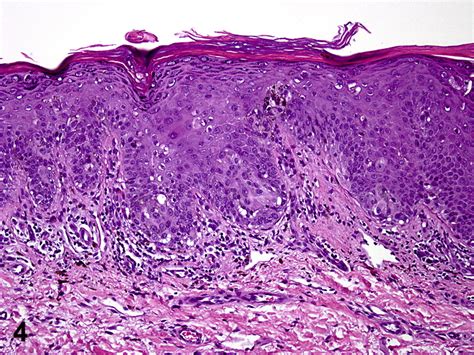 Scrotal Rash In A 68 Year Old Man Journal Of The American Academy Of