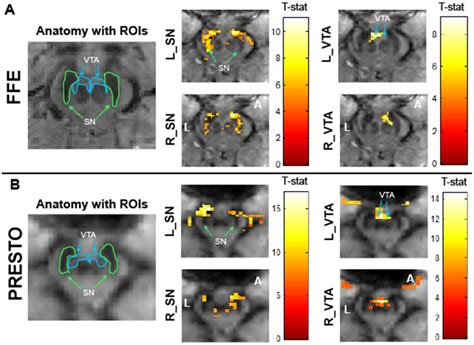Roi Seed Based Functional Connectivity Maps In The Midbrain For 3 D