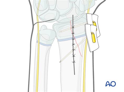 Open Reduction K Wire Fixation For 23r E 4 1 Simple Epi Metaphyseal