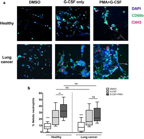 G Csf Induces Robust Netosis In Human Neutrophils Circulating