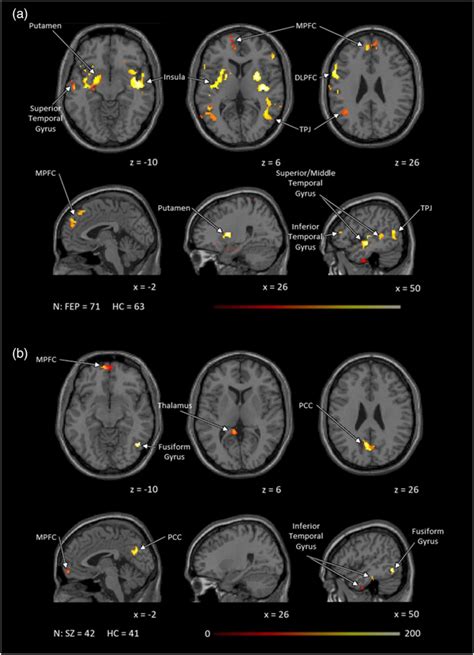 Putamen Resting State Functional Connectivity Patient Versus Control