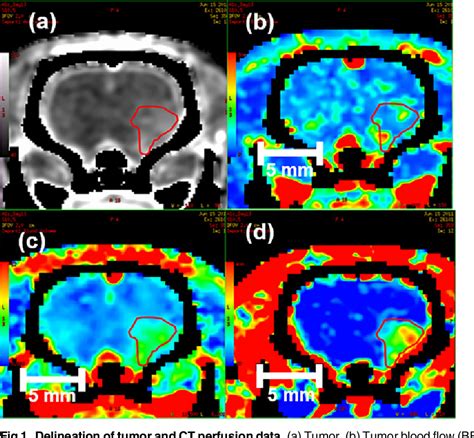 Figure 1 From Evaluation Of Ct Perfusion Biomarkers Of Tumor Hypoxia