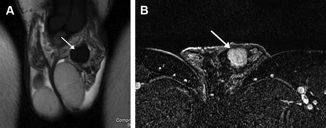 Mr Imaging Of The Testicular And Extratesticular Tumors Radiology Key