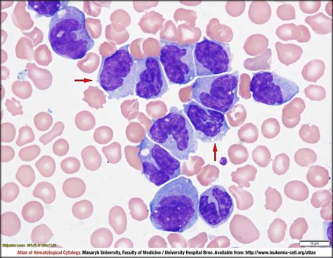 Myeloid Neoplasms With Germline Runx1 Mutation Cell Atlas Of
