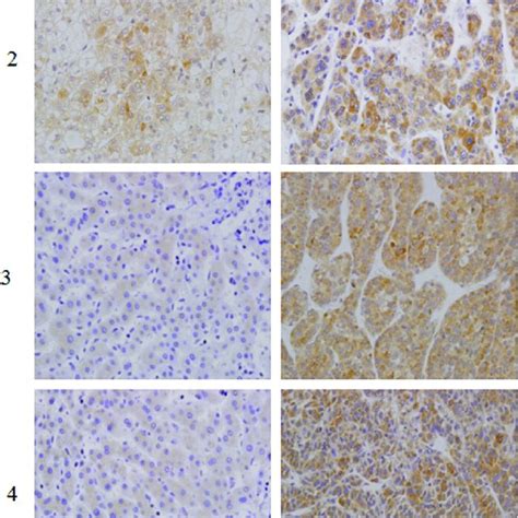 Numb Expression Level Up Regulated In The Primary Hcc Tissues Compared