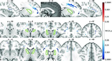 Voxel Wise Group Differences In Fractional Anisotropy Fa Using