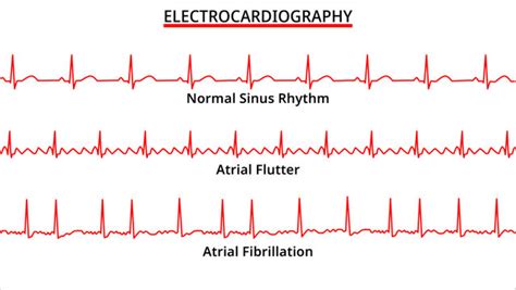Atrial Fibrillation Vs Atrial Flutter Ecg