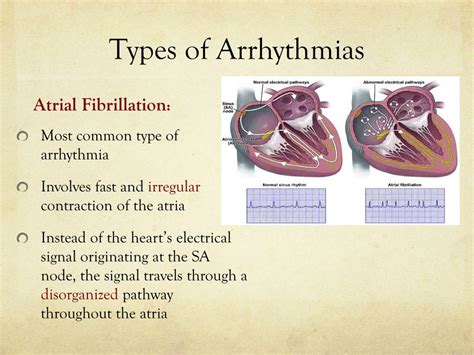 Ppt Antiarrhythmic Agents Powerpoint Presentation Free Download Id