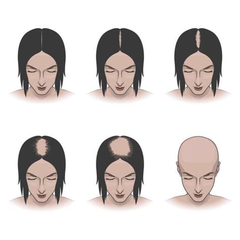 430 Female Alopecia Stock Illustrations Royalty Free Vector Graphics