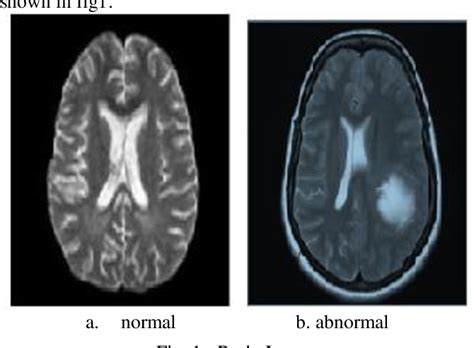 Figure 1 From Detection And Classification Of Brain Cancer Using Bpnn