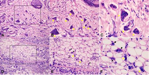 Histologic Findings Of Poorly Differentiated Cluster And Tumor Budding