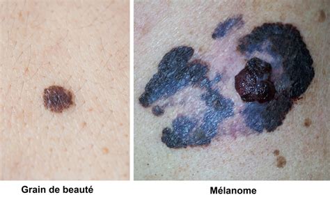 Grain De Beauté Ou Cancer Comment Faire La Différence