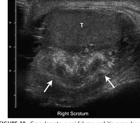 Figure 10 From Imaging Of The Epididymis Semantic Scholar