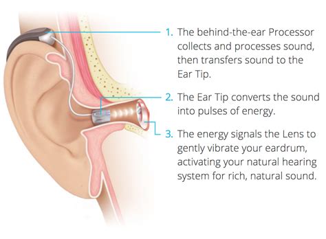 Earlens Overview Ear Institute Of Chicago