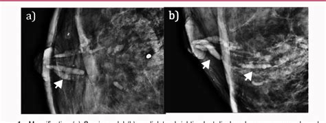[pdf] Intraductal Extracapsular Rupture Of Silicone Breast Implant