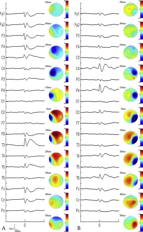 Spatiotemporal Analysis Data For Patient 7 Columns A And B Show Left