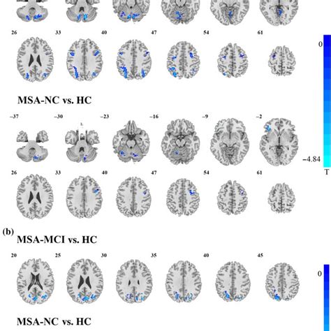 Brain Regions Showing Differences In Functional Connectivities