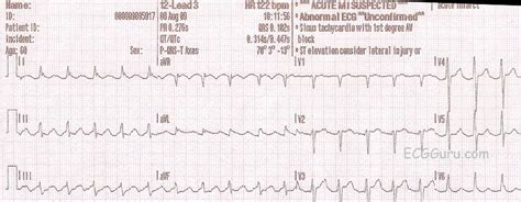 10 tips to never miss atrial flutter with 2 1 conduction