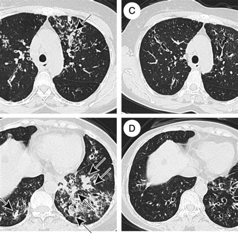 Chest High‐resolution Computed Tomography Before A B And 12 Months