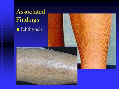 Ppt Atopic Dermatitis Powerpoint Presentation Free Download Id 4929119