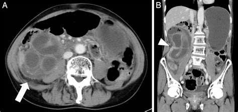 Paracolic Lymph Node Semantic Scholar