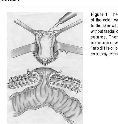 Figure 1 From Resection And Primary Anastomosis With Or Without