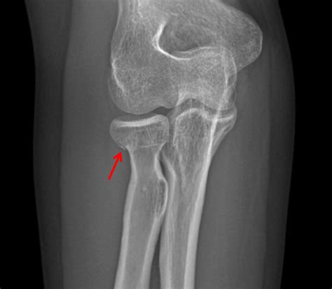 Proximal Radius Fracture