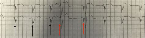 Dr Smiths Ecg Blog A Patient With Ischemic Symptoms And A