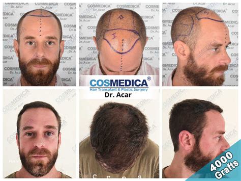 Haartransplantation Türkei Istanbul Dr Levent Acar