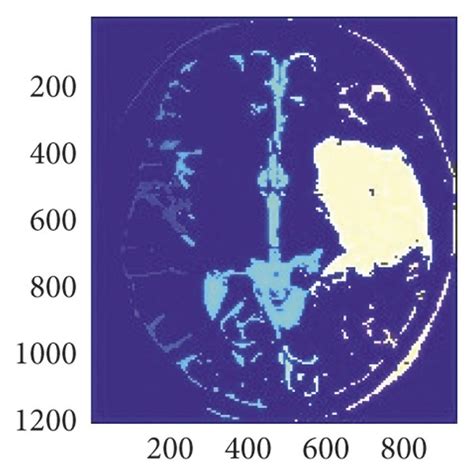 Tumor In Brain Region Segmentation In A Sample Tumor Brain Mri Image