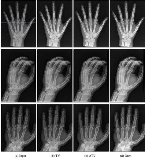 [pdf] Quantum Noise Removal In X Ray Images With Adaptive Total