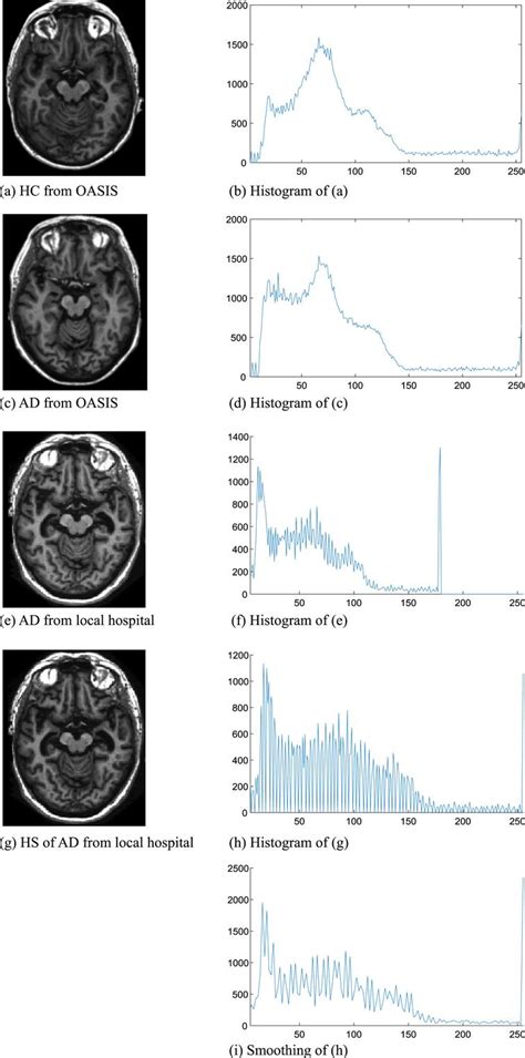 multivariate approach for alzheimer s disease detection using