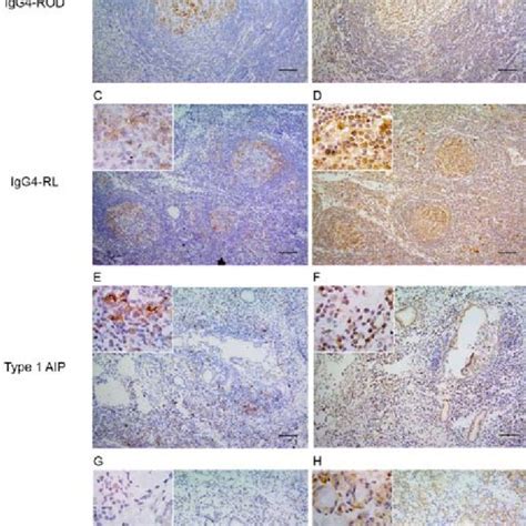 Frequency Of Cd4 Cxcr5 Tfh Cells Among Patients With Igg4 Rd P